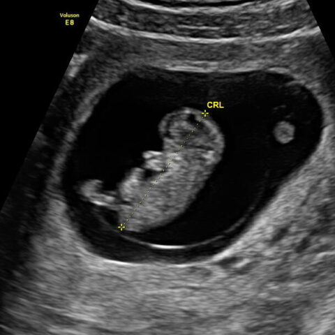 2D Ultrasound | Early Pregnancy Ultrasounds | 3D Baby Boutique